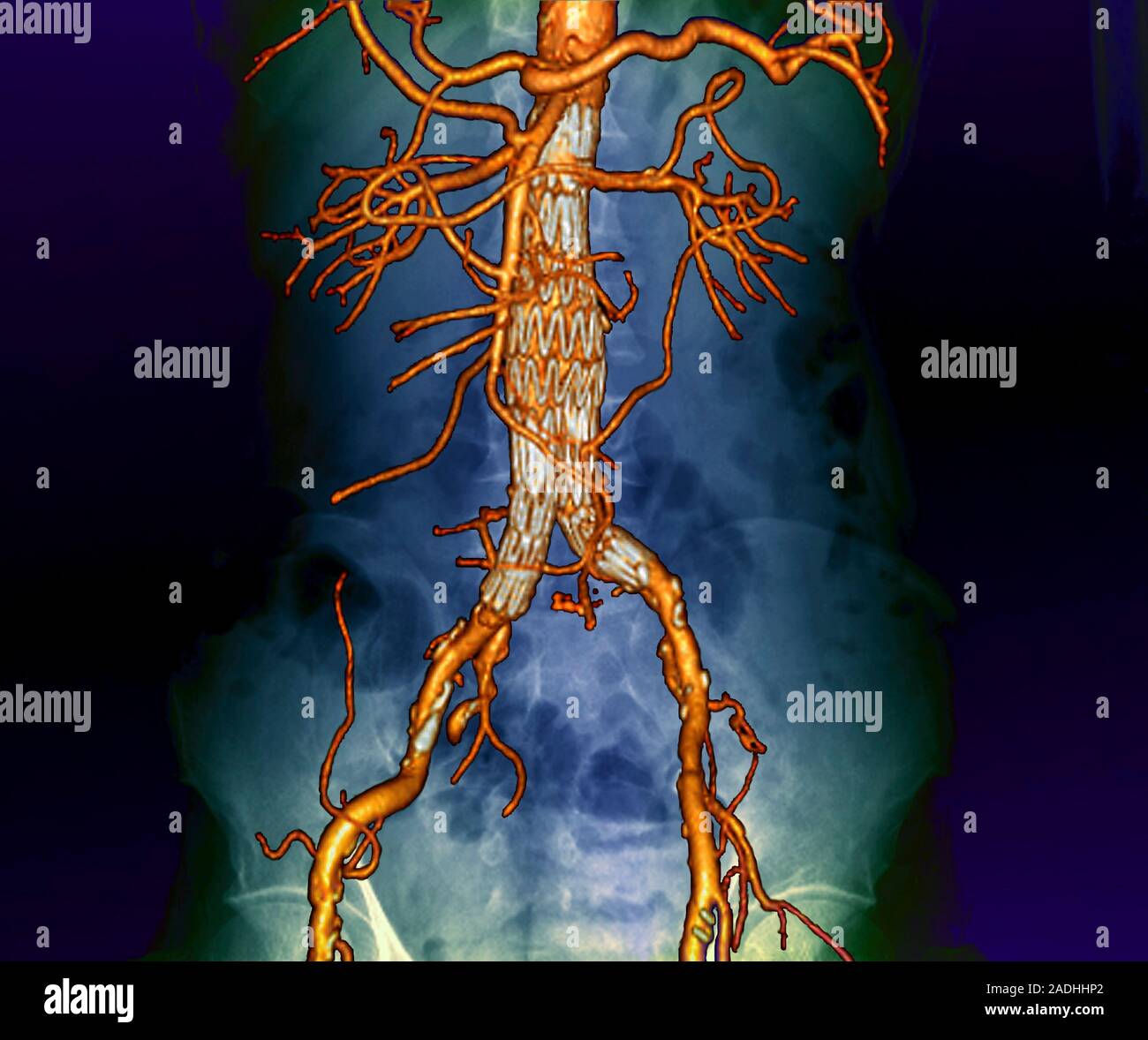 Stent in the abdominal aorta. Coloured 3D computed tomography (CT) scan ...
