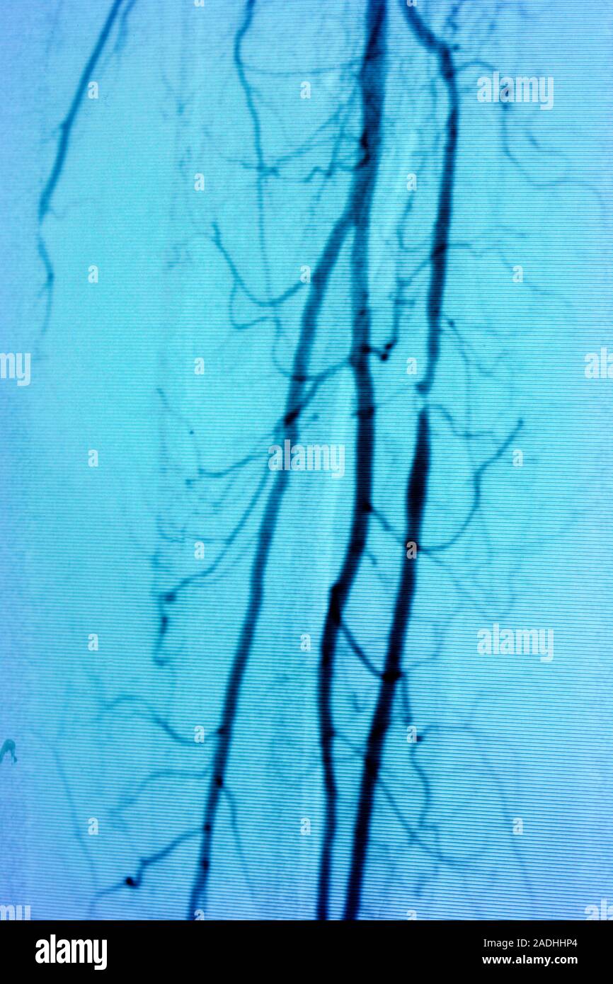 Stenosis of leg vessels. Angiogram of severely narrowed (stenosed ...