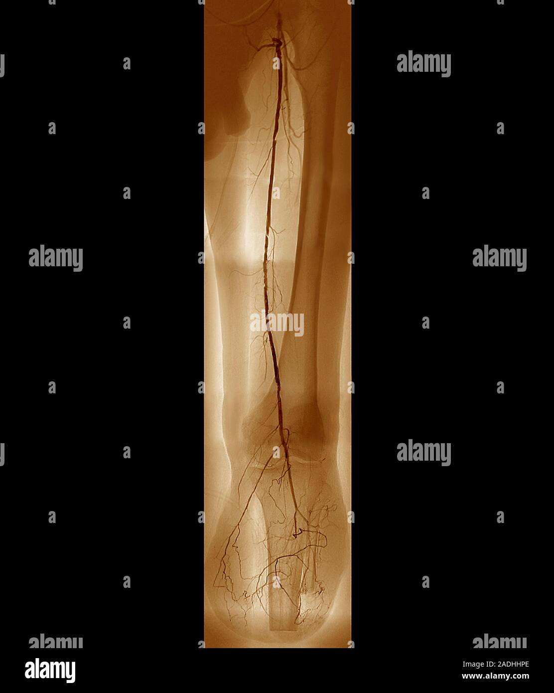 Arteritis. Coloured angiogram of the left leg of a 53 year old patient ...