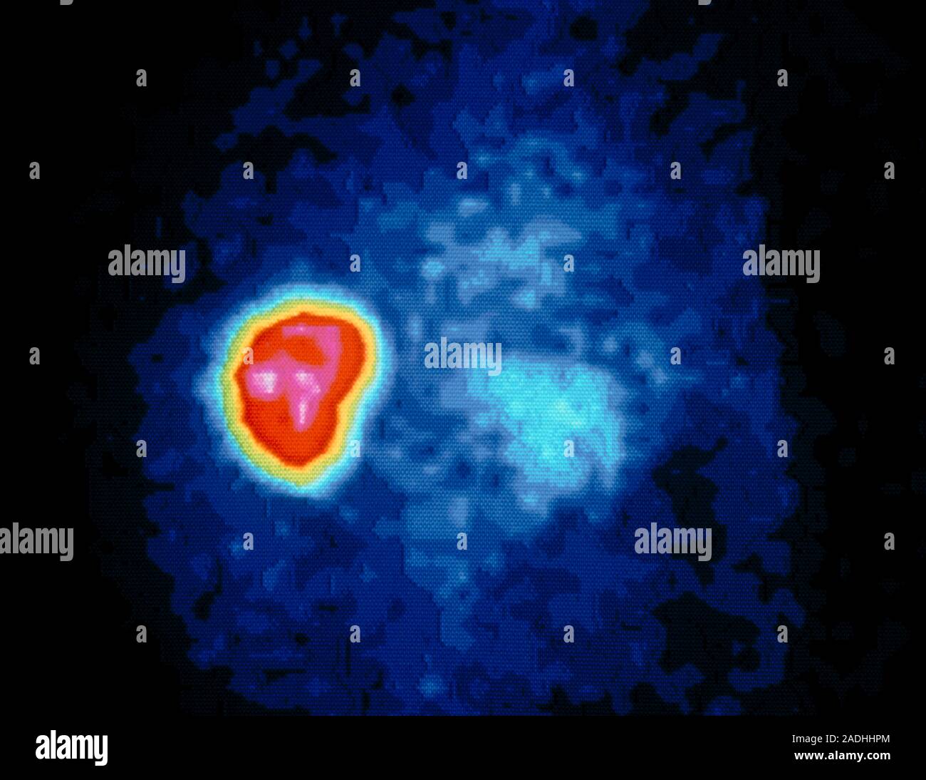 False colour scintigram (gamma camera scan) of human kidneys, showing ...