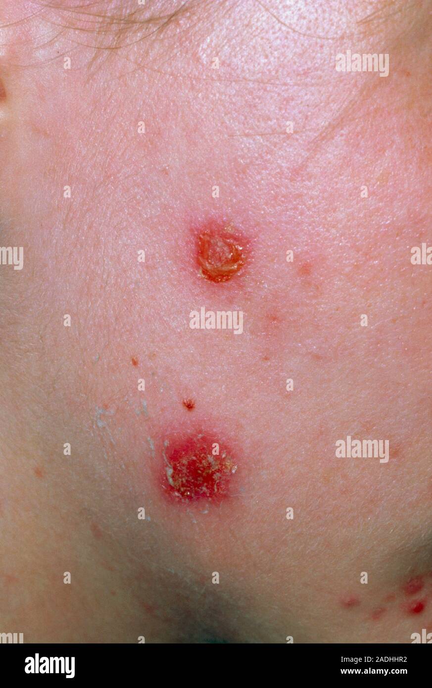 Impetigo rash on a woman's cheek which developed following cosmetic ...