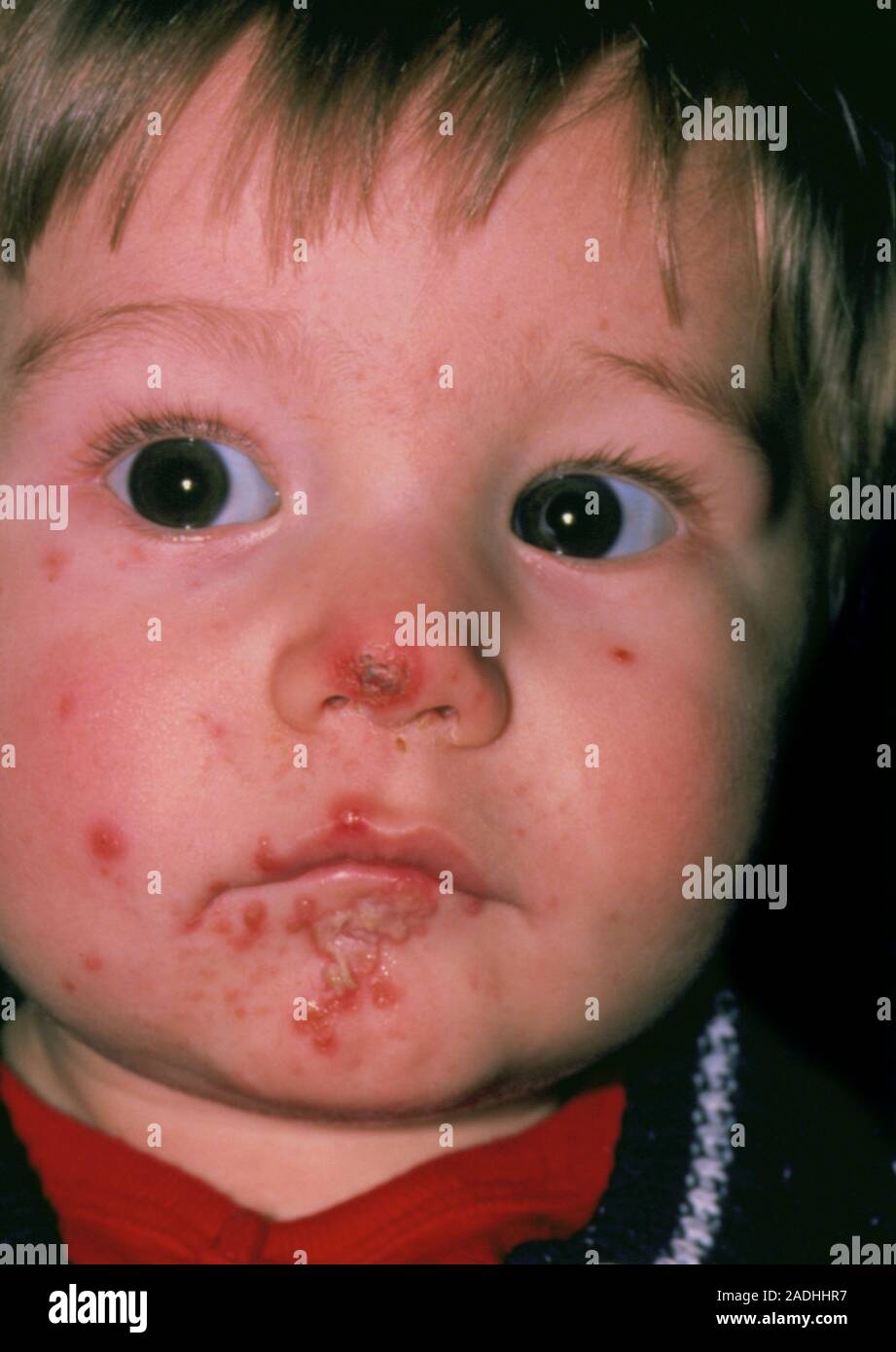 Impetigo: bacterial skin infection affecting an infant's chin. These ...