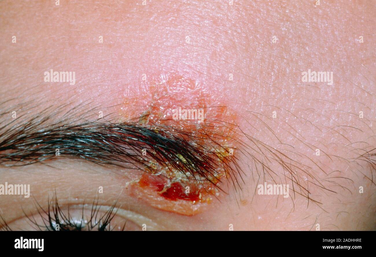 Impetigo. Crusty, honey-coloured sore around a woman's eyebrow, caused ... Impetigo. Crusty, honey-coloured sore around a woman's eyebrow, caused ...