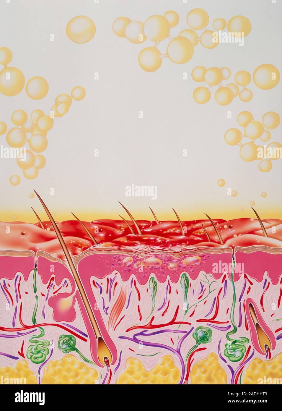 Impetigo. Artwork of a section through skin with impetigo, a skin ...