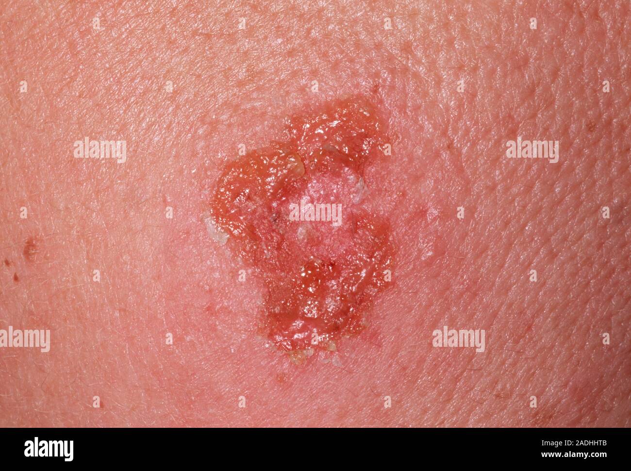 Impetigo infection on the cheek of a 45-year-old woman. Impetigo is a ...
