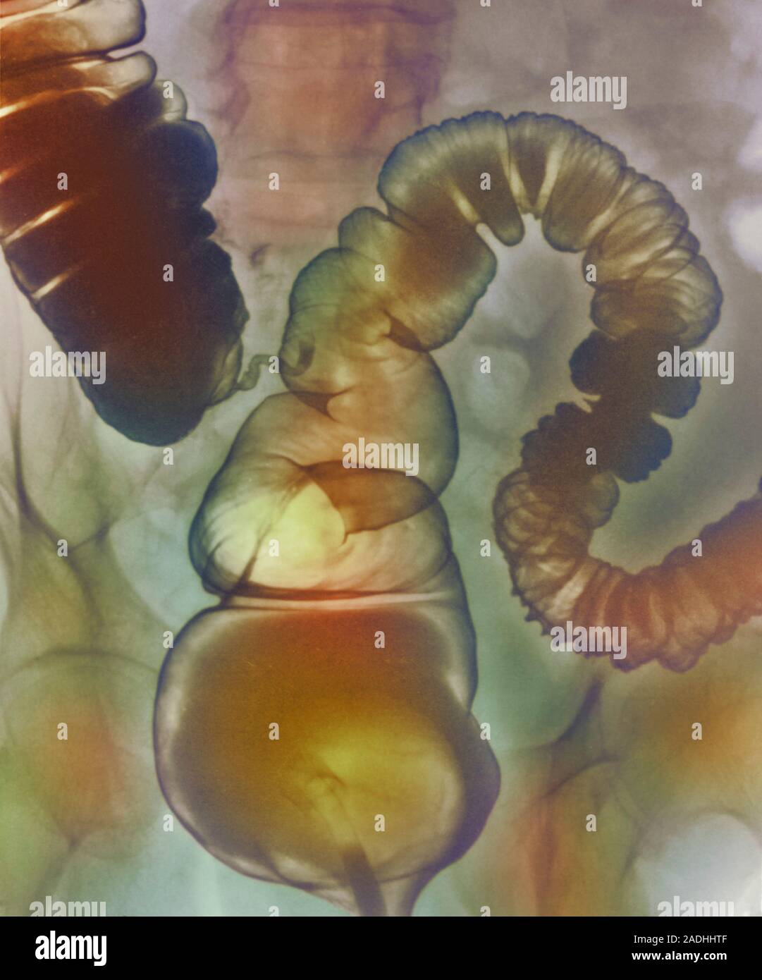 Irritable bowel syndrome (IBS). Coloured X-ray of the sigmoid colon ...