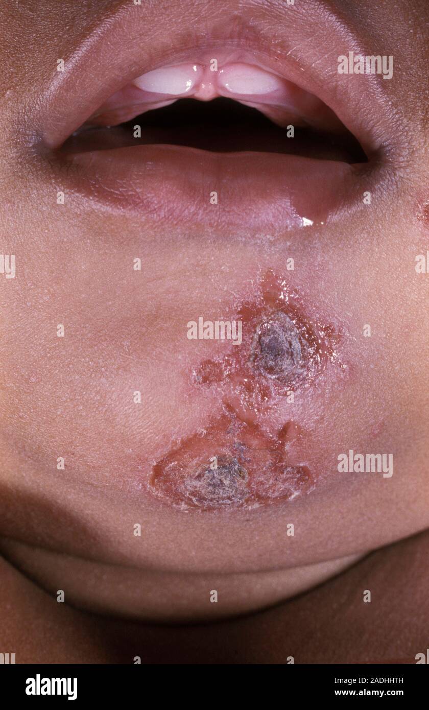 Impetigo infection on a child's chin. Impetigo is a highly contagious skin infection caused by ...