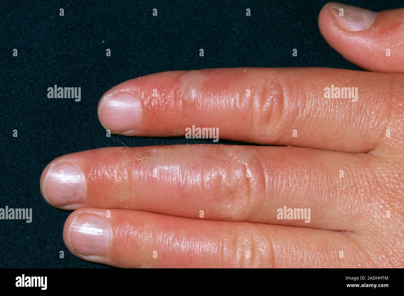 Skin infection. Blisters on a 6-year-old girl's hand from bullous ...