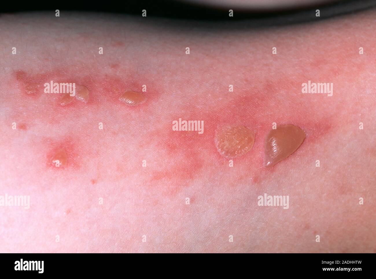 Skin infection. Blisters on a 6-year-old girl's arm from bullous ...