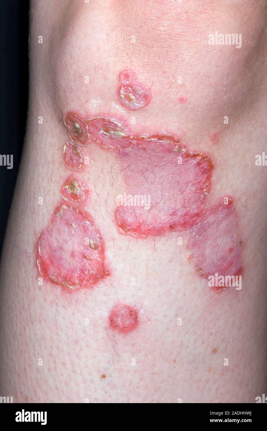 Impetigo rash on an 18 year old girl's leg. Impetigo is a bacterial skin infection caused by ...
