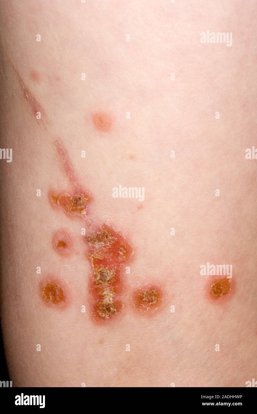 MODEL RELEASED. Impetigo rash on a 6 year old boy's leg after a minor ...