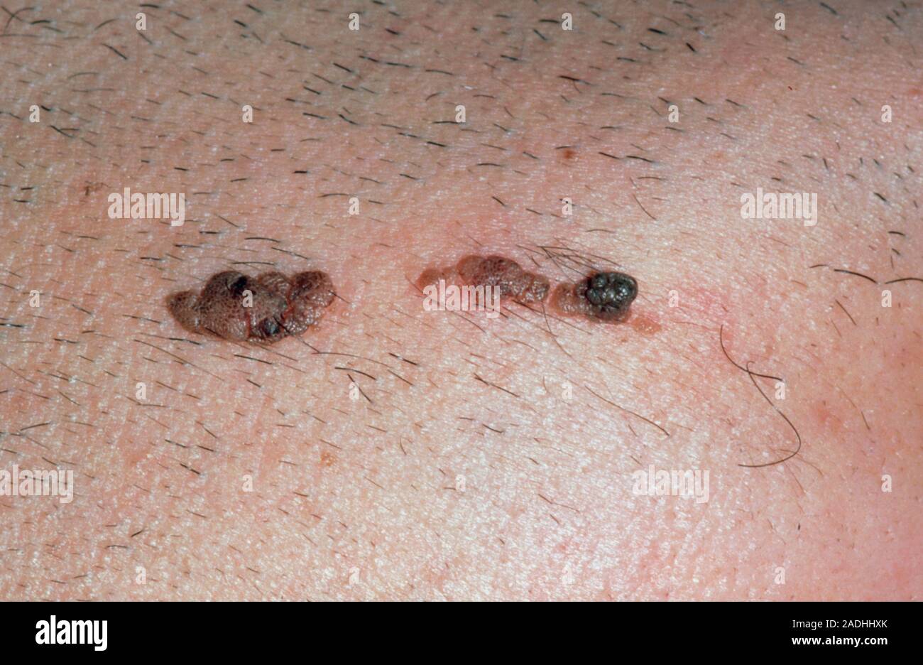 Close-up showing seborrhoeic keratoses, also known as seborrhoeic warts ...