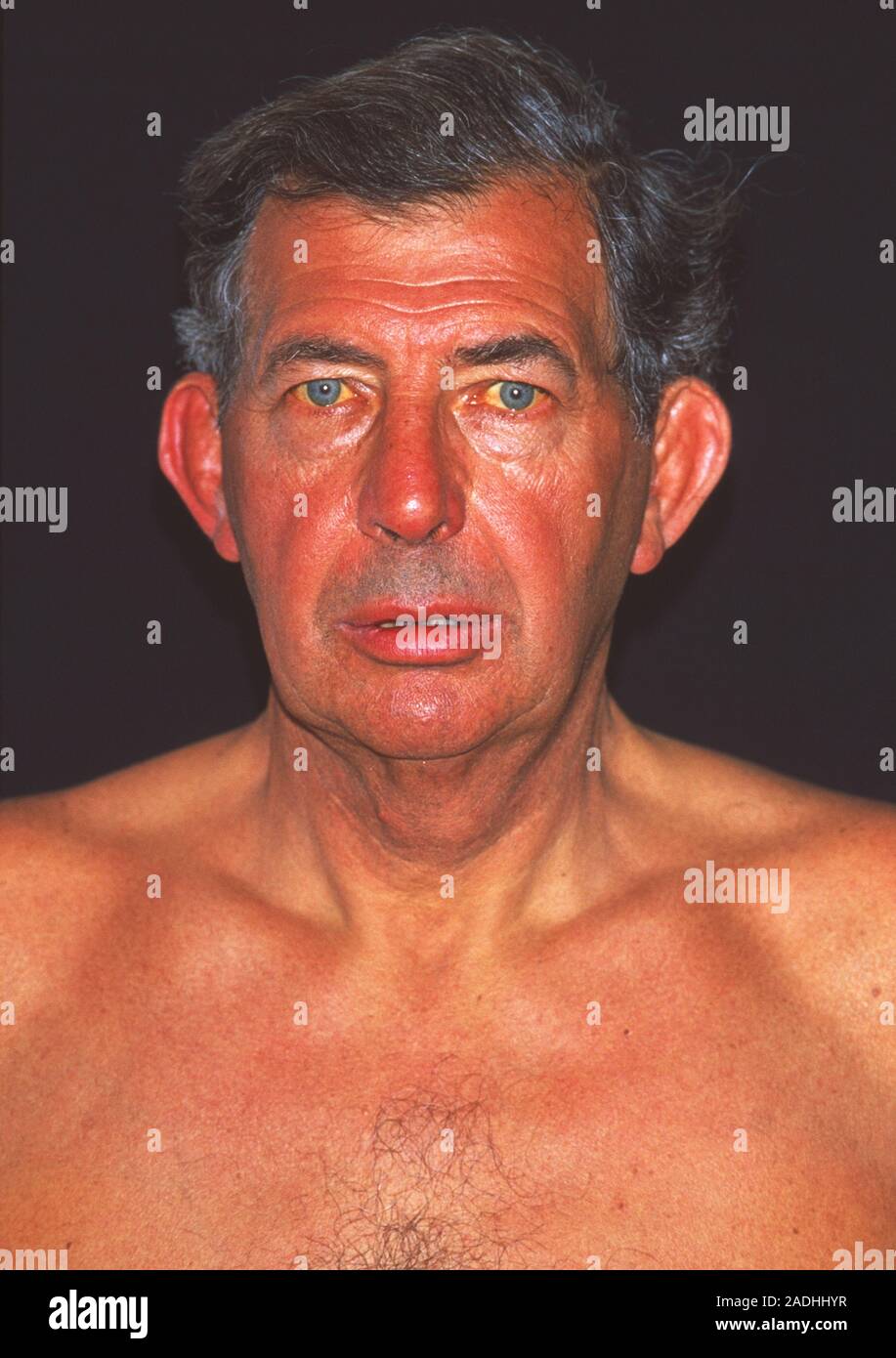 Jaundice. 61-year-old man suffering from hepatitis A. This is a viral disease that results in ...