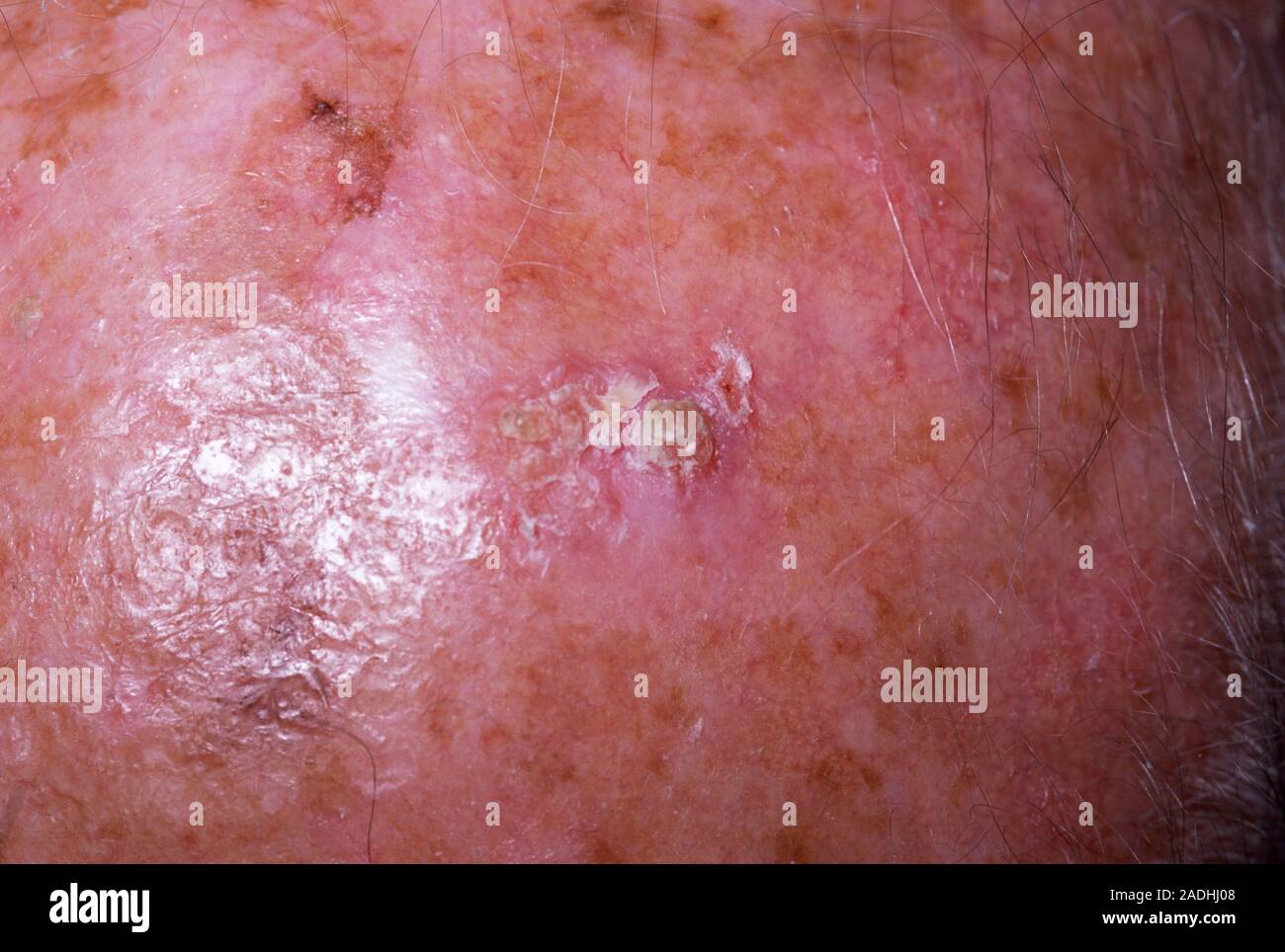 Solar keratosis on an 84-year-old man's scalp. Also known as an actinic ...