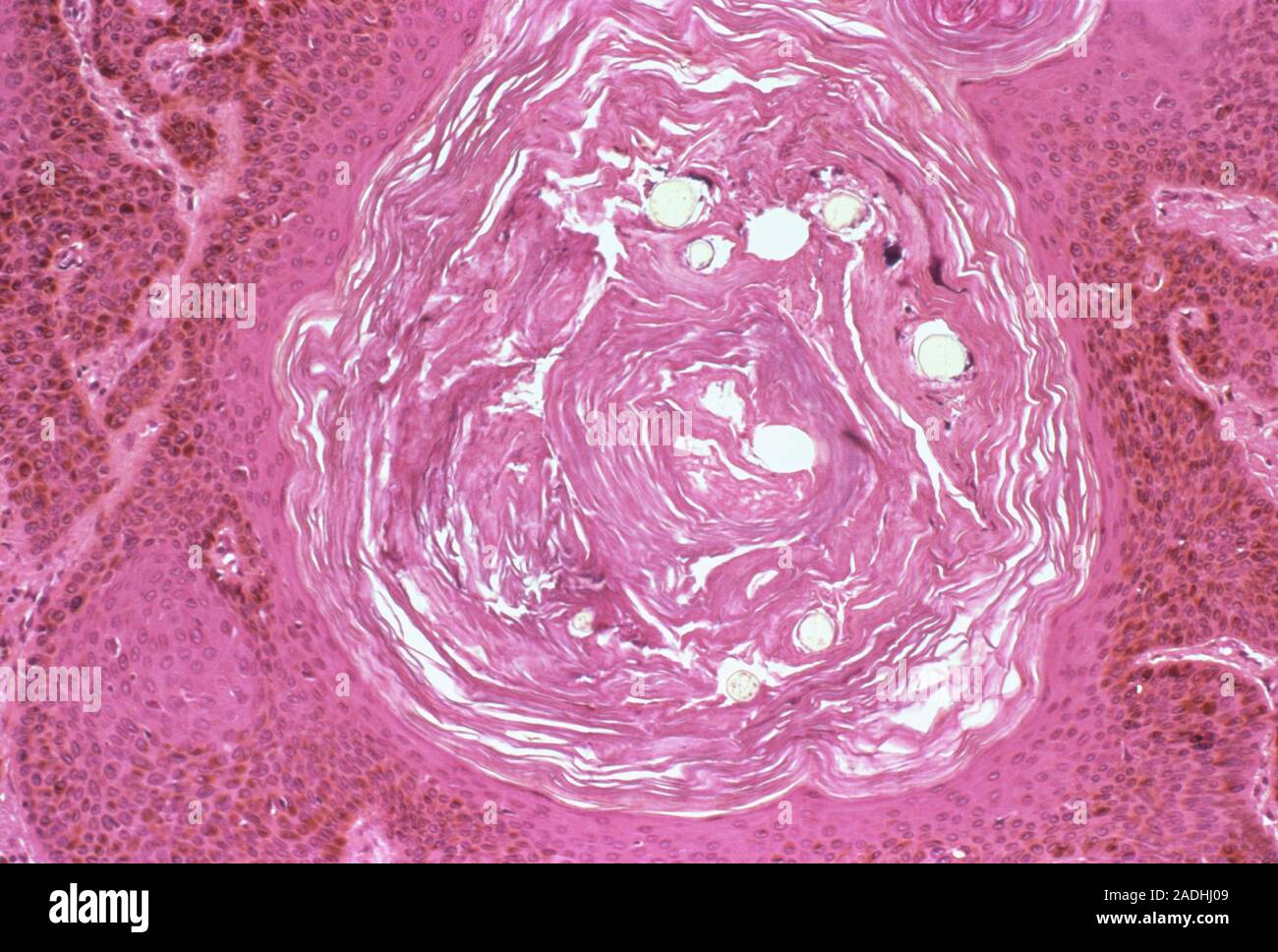 Seborrhoeic wart. Light micrograph of a section through a seborrhoeic ...