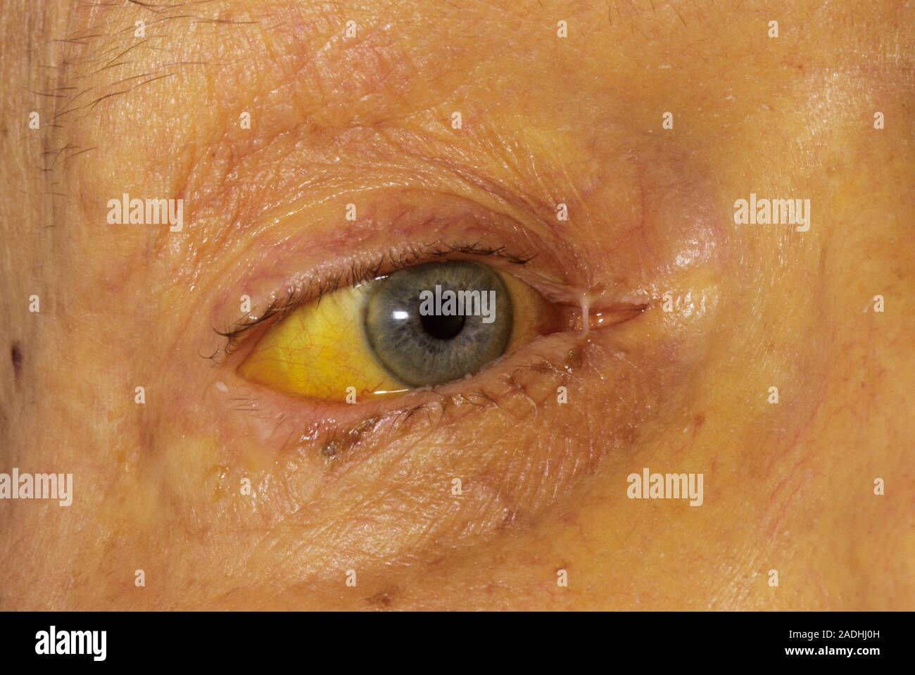 Jaundiced eye of a 60 year old man caused by pancreatic cancer. A ...