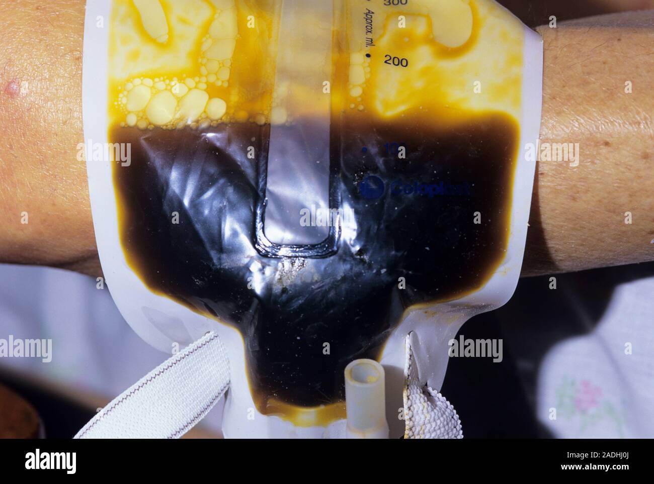 Jaundice. Dark urine and yellow skin from a 60 year old man caused by ...