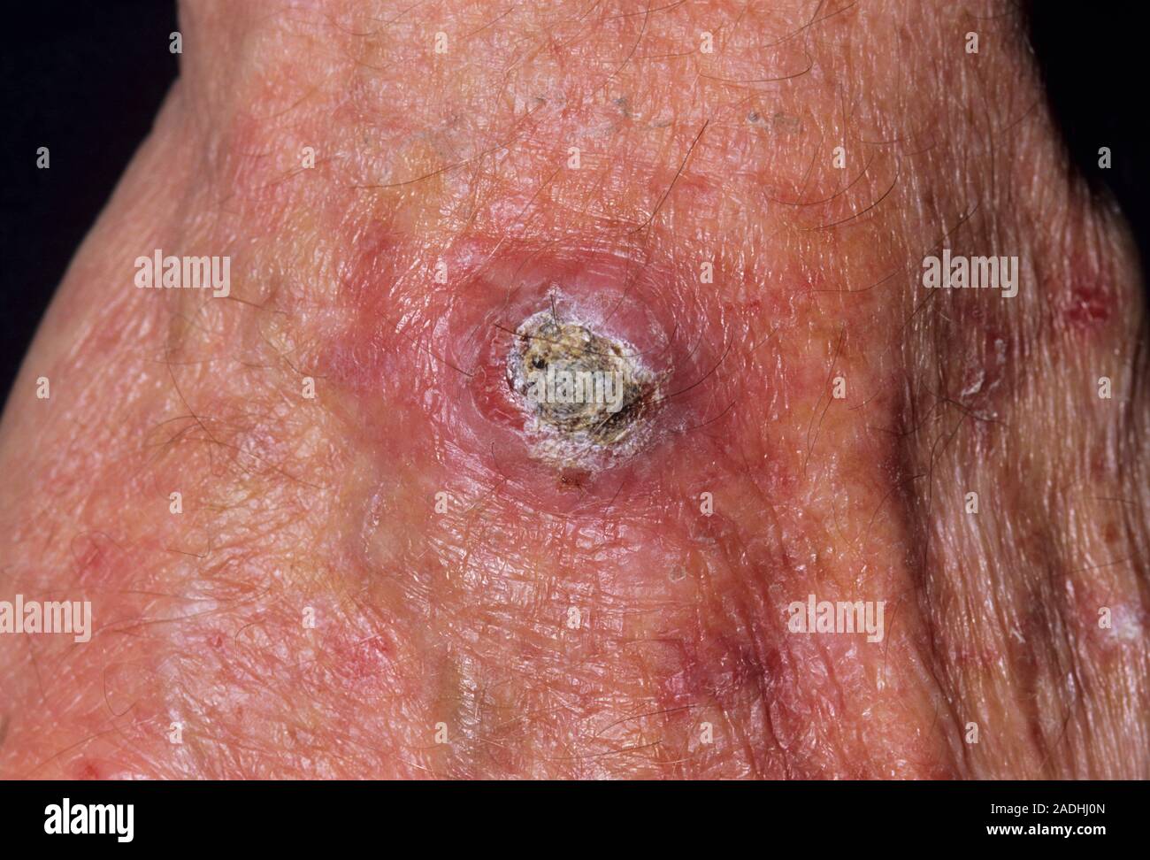 Keratoacanthoma. Large keratoacanthoma, also known as molluscum sebaceum, on the back of a 73 ...