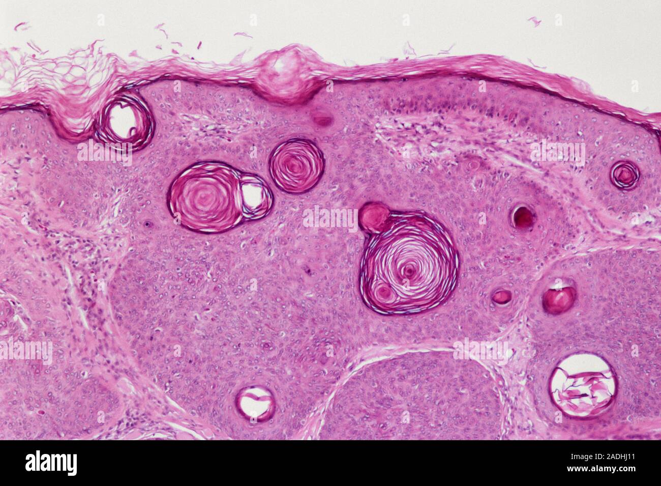 Seborrhoeic wart. Light micrograph of a section through a seborrhoeic ...