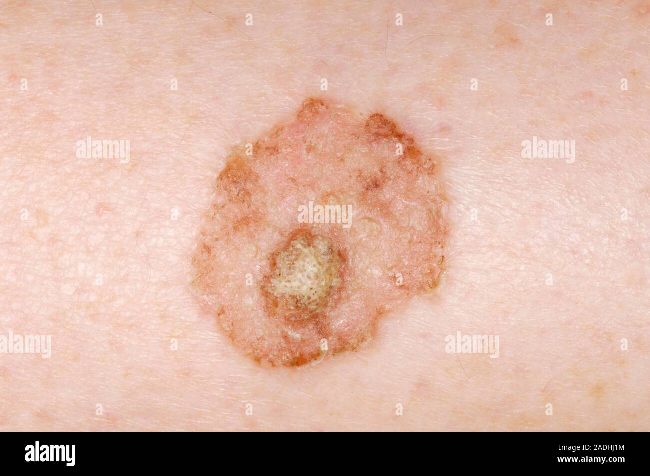 Seborrhoeic wart on a 21-year-old man's skin. This is a benign (non ...