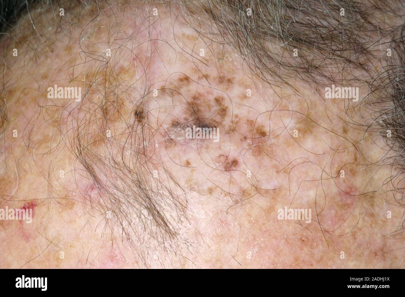 Follow-up to seborrhoeic wart treatment. Remains of a a seborrhoeic ...