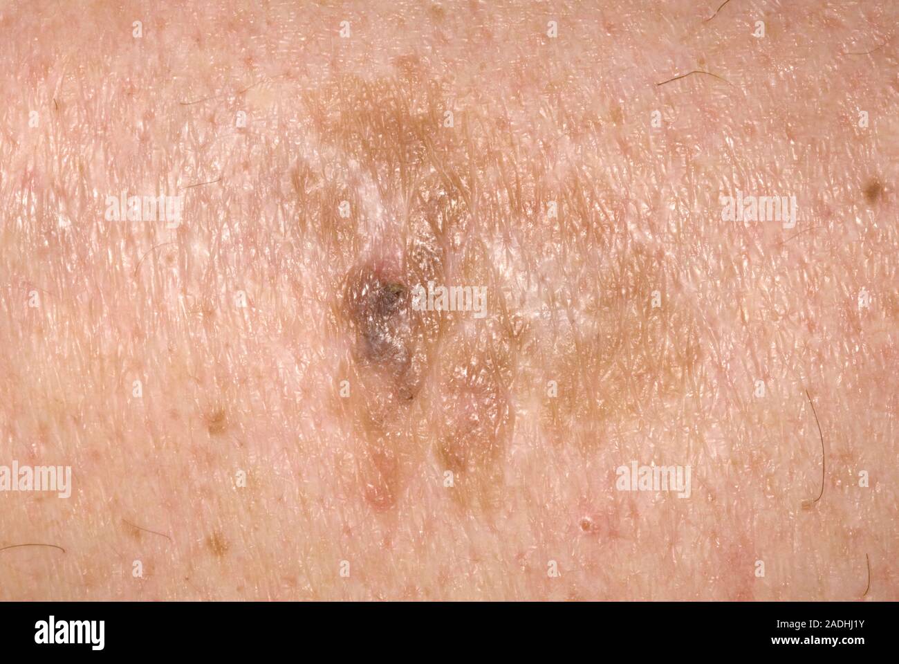 Solar keratosis growth (dark brown) with multifocal dysplasia (multiple ...