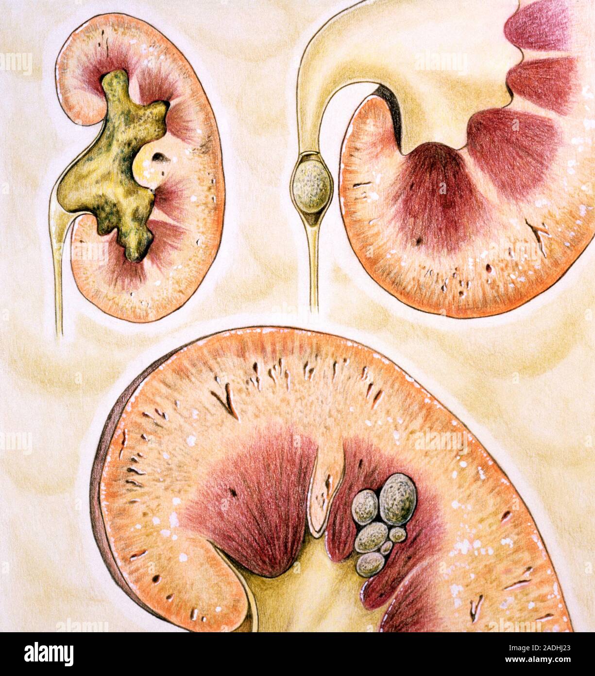 Kidney and ureteral stones (calculi). They are caused by precipitation ...