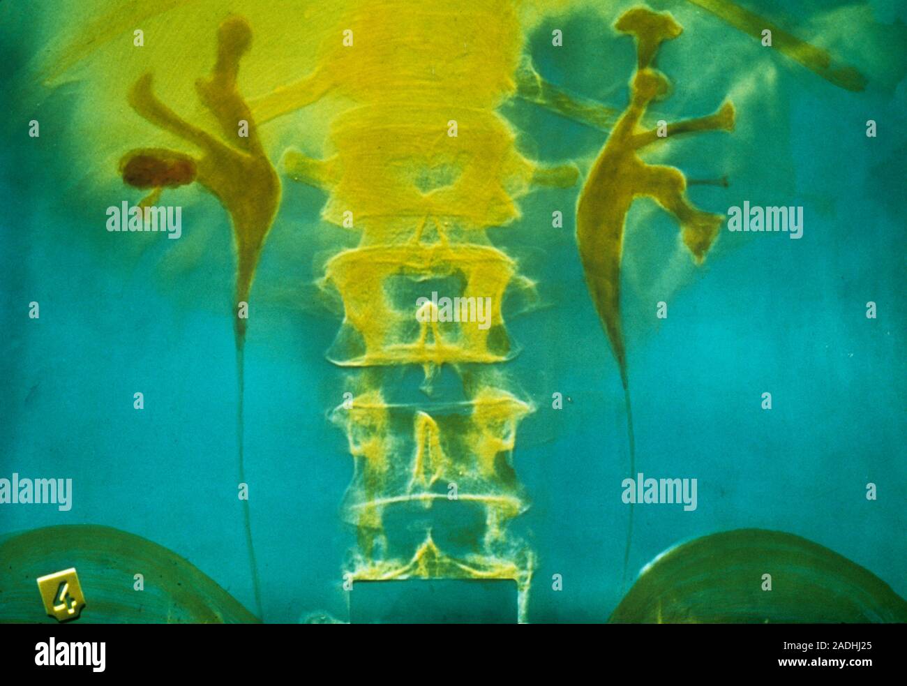False-colour intravenous pyelogram (IVP) showing presence of a kidney ...