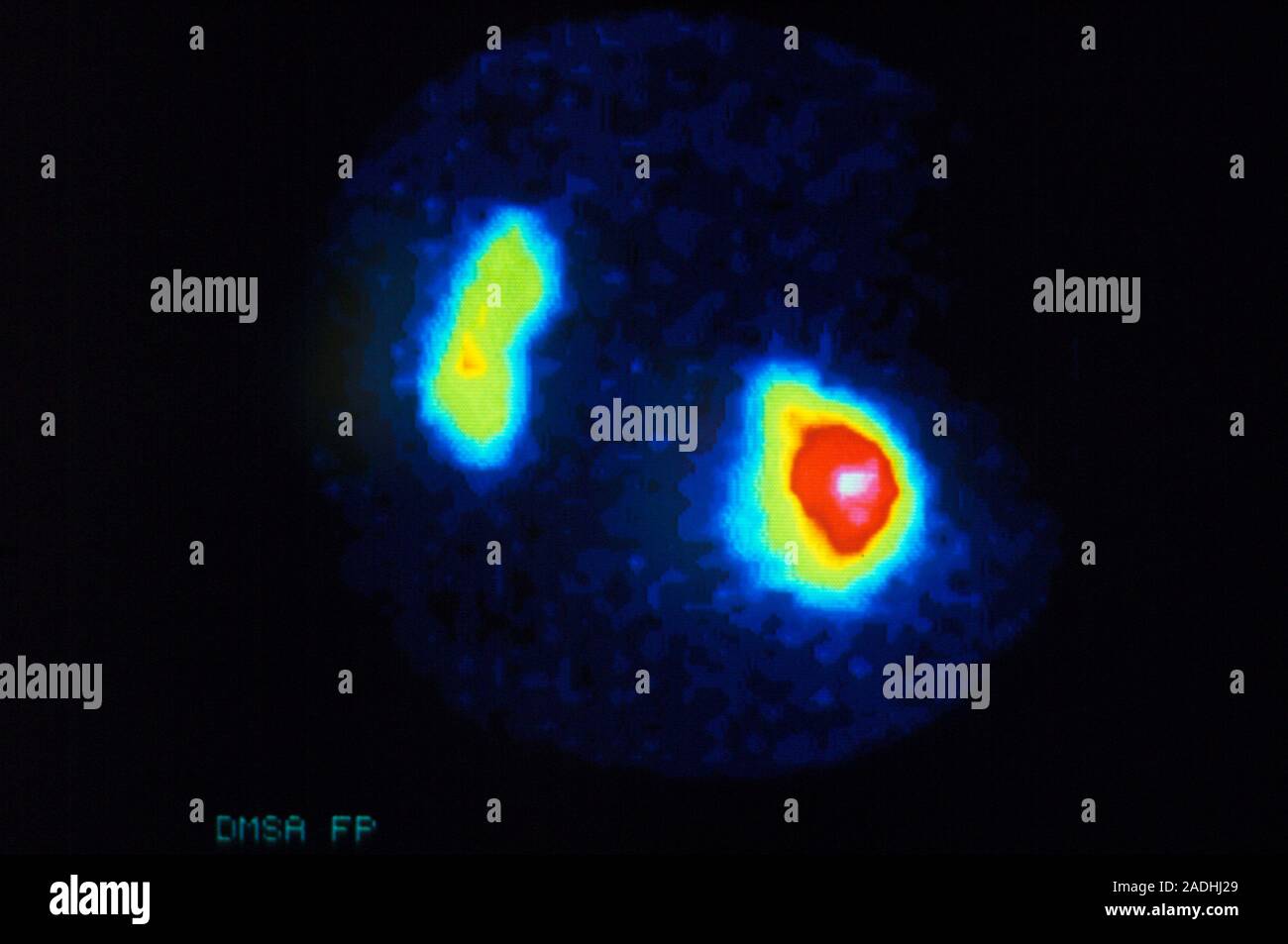 False colour scintigram (gamma camera scan) of human kidneys affected ...