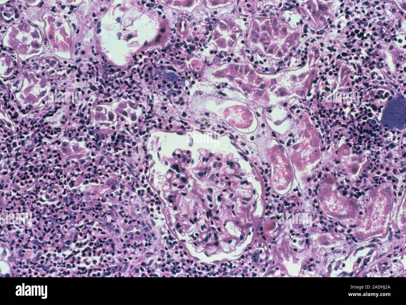 Light micrograph of a human kidney in acute pyelonephritis. Pyogenic ...