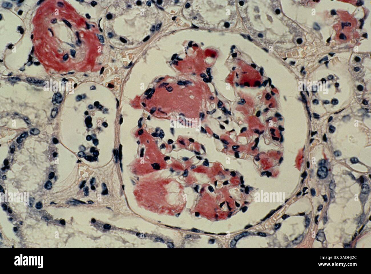 Light micrograph of a human kidney showing amyloid deposits (pink) in a ...