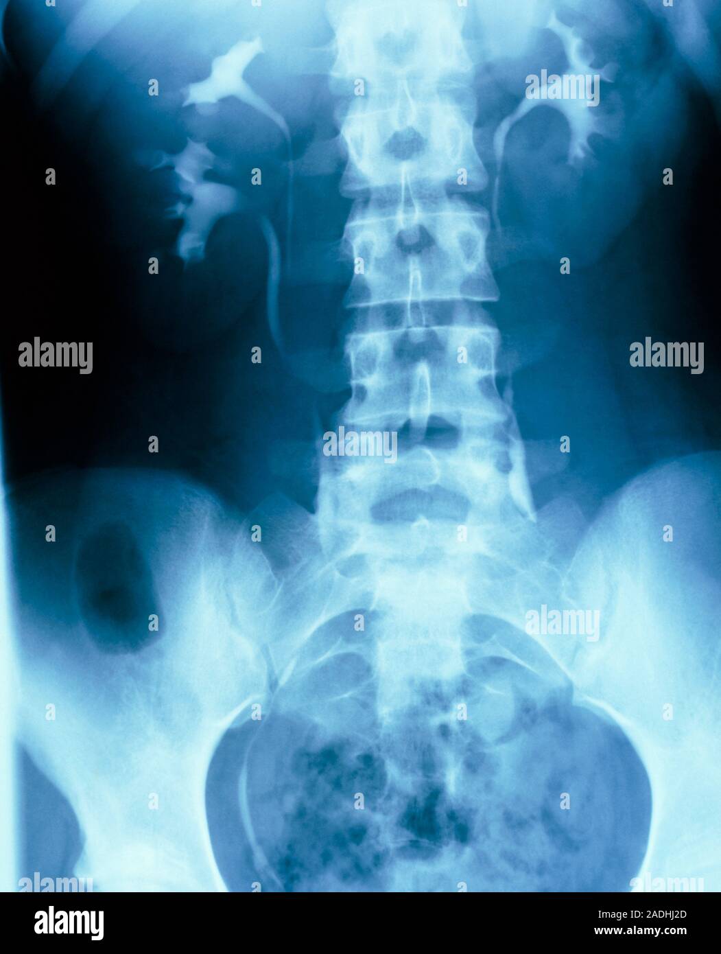 Duplex kidney: intravenous pyelogram (IVP), an X- ray image of the ...