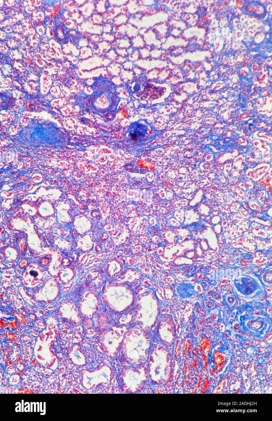 Glomerular atrophy. Light micrograph of human kidney tissue showing a ...