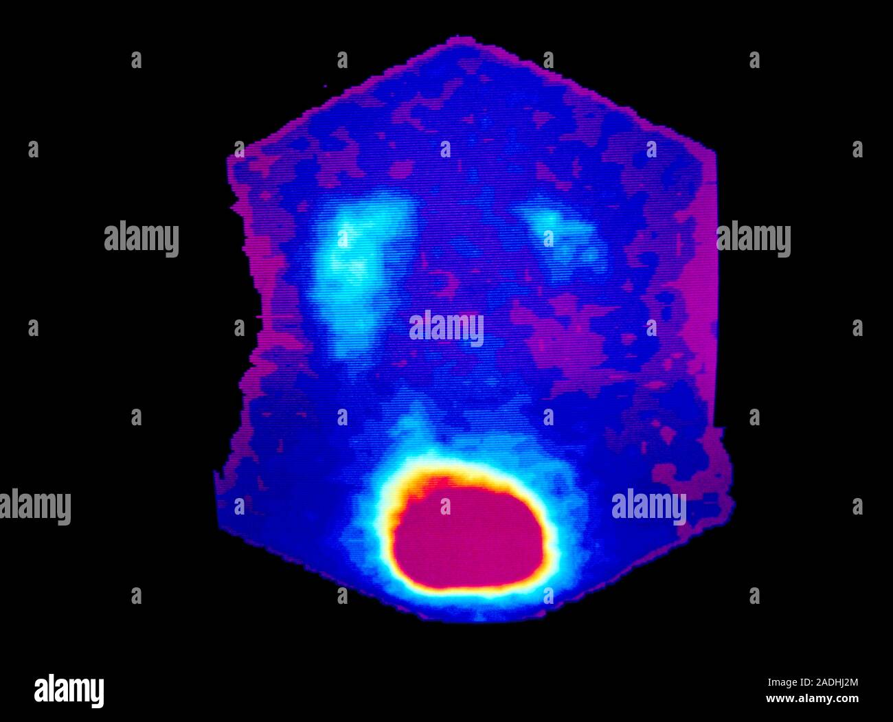Urinary reflux. Coloured Gamma Camera Scan (scintigram) of the human ...