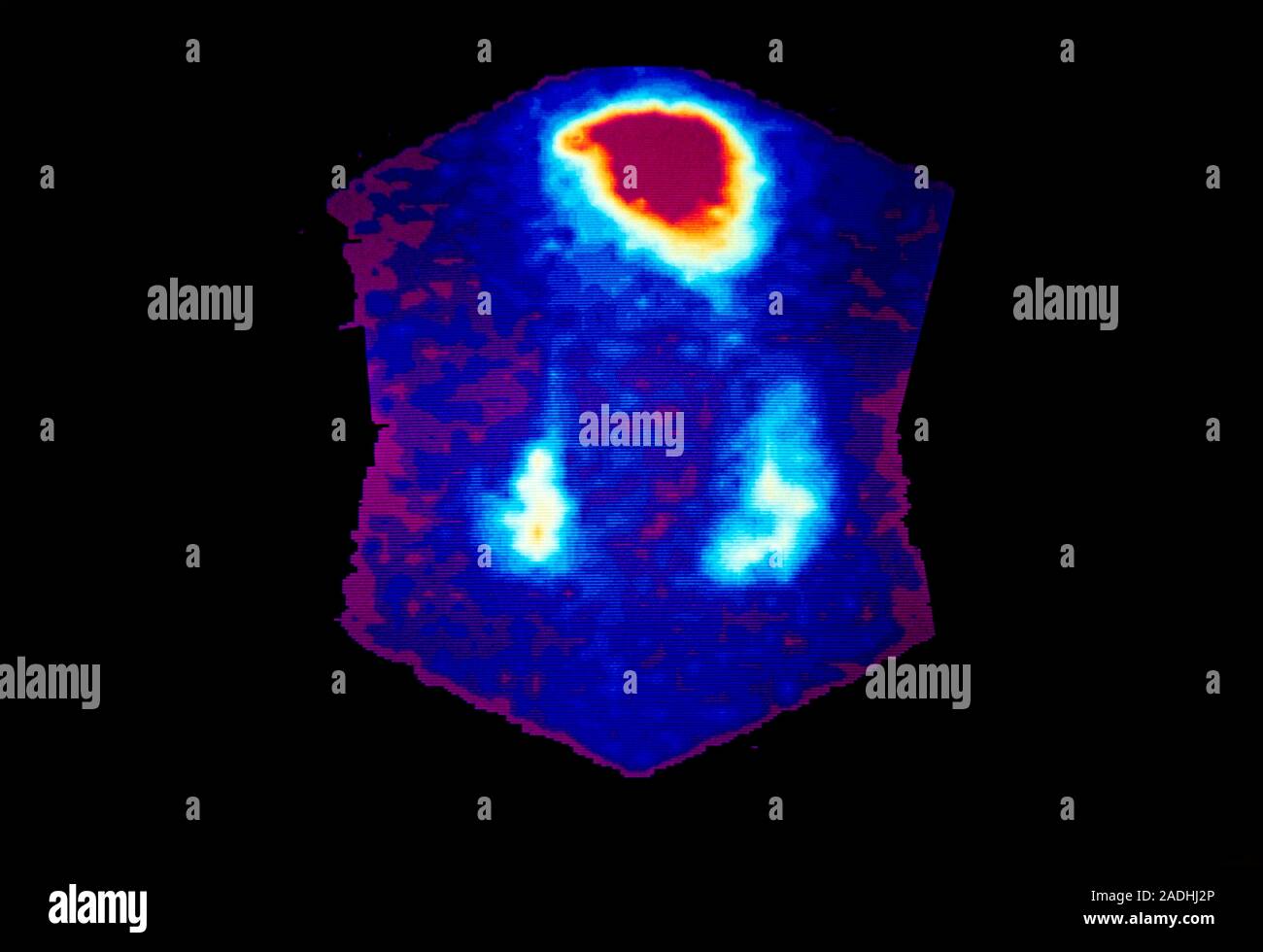 Urinary reflux. Coloured Gamma Camera Scan (scintigram) of the human ...