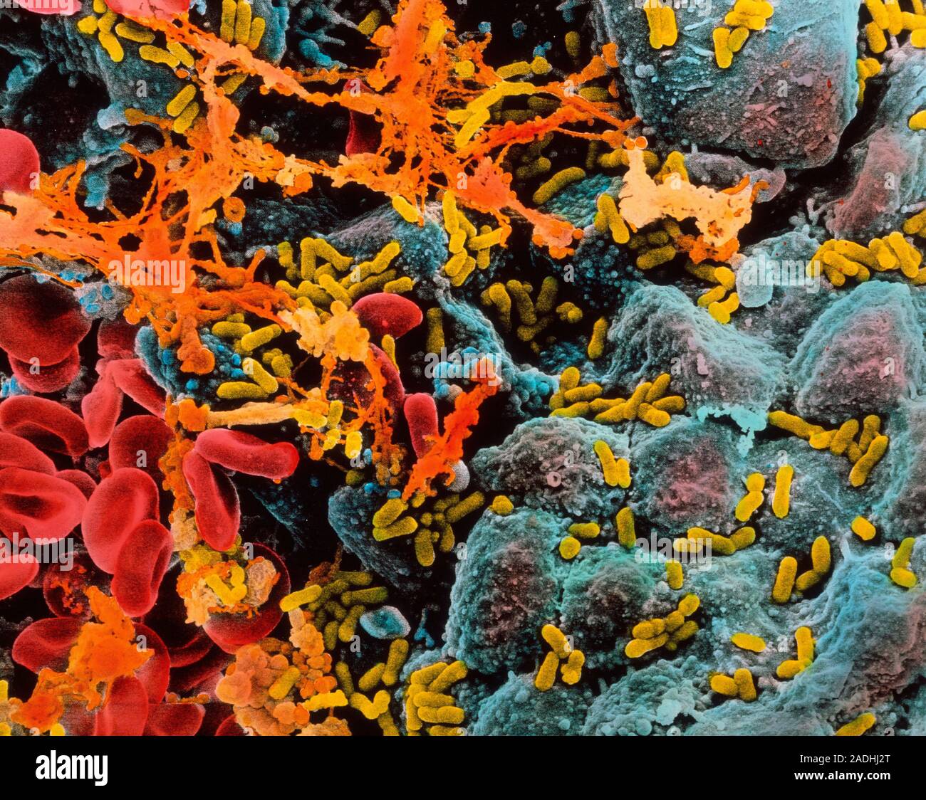 Bacterial infection of bladder (cystitis). Colour Scanning Electron ...