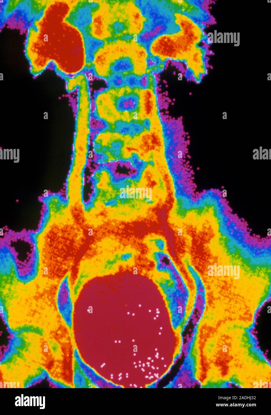 Urinary reflux. Coloured X-ray urogram showing reflux (back-flow) of ...