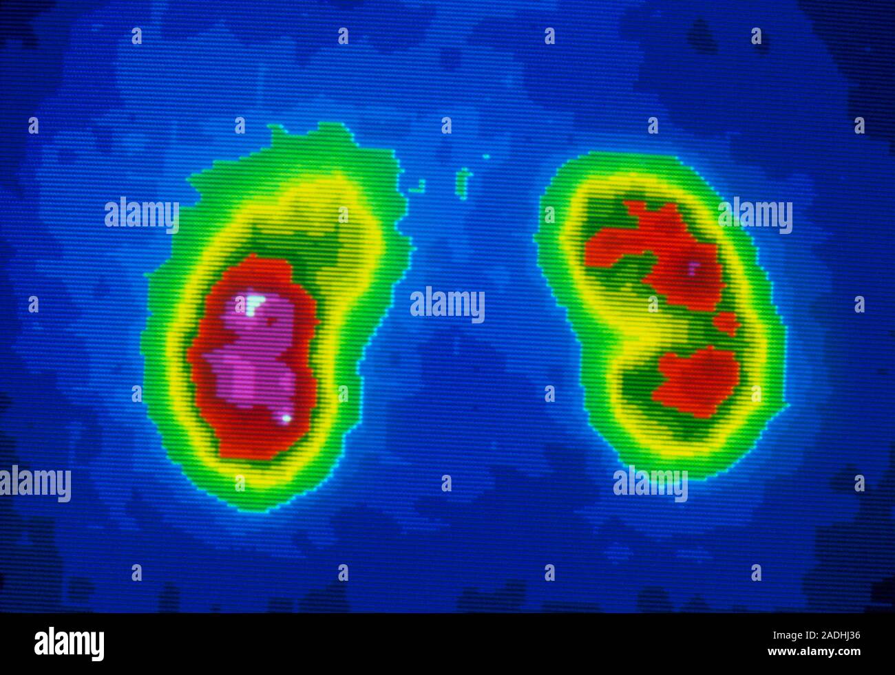 Kidney failure. Coloured gamma scan showing kidney failure in a patient ...