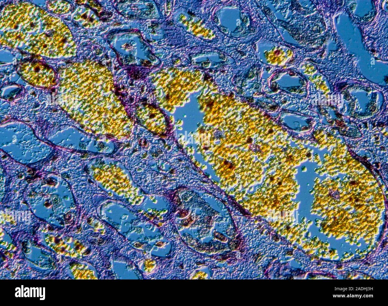 Candida kidney infection. Light micrograph of a section through a human ...