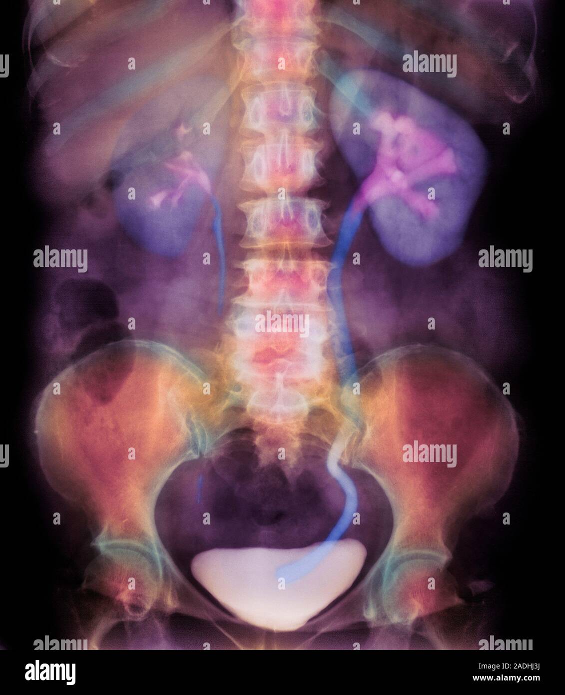 Kidney stone in ureter. Coloured urogram (X-ray) of a patient's abdomen ...
