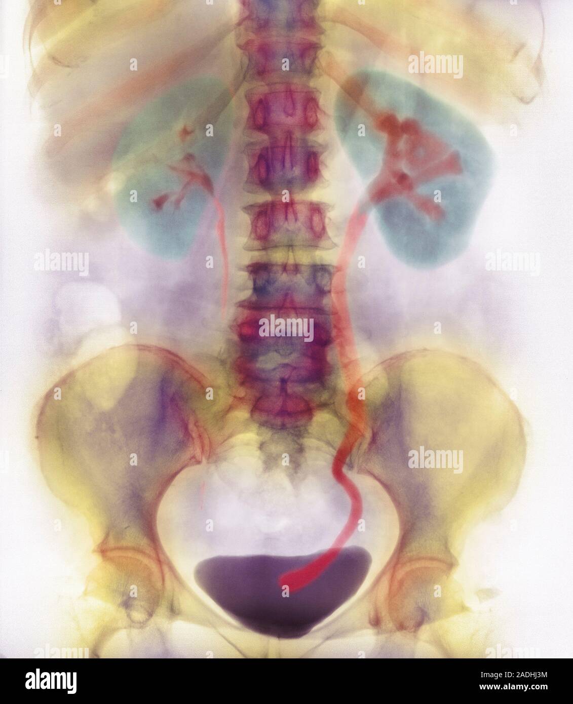 Kidney stone in ureter. Coloured urogram (X-ray) of a patient's abdomen ...
