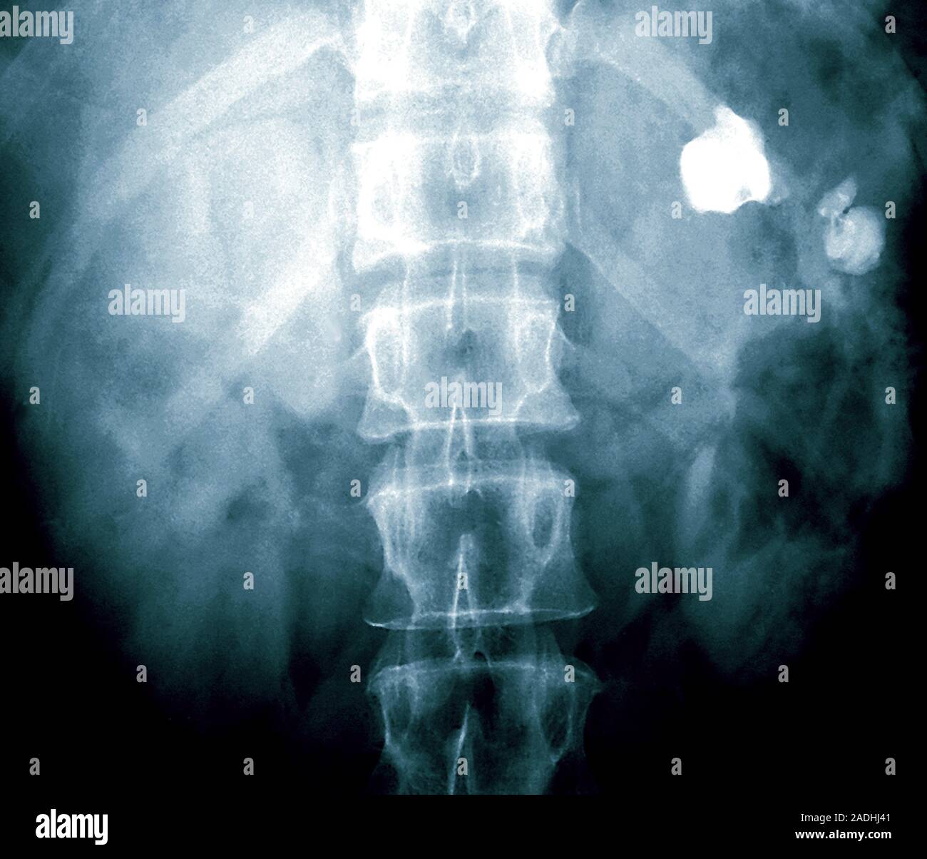 Kidney stone. X-ray of a stone (white, upper right) in the kidney of a ...