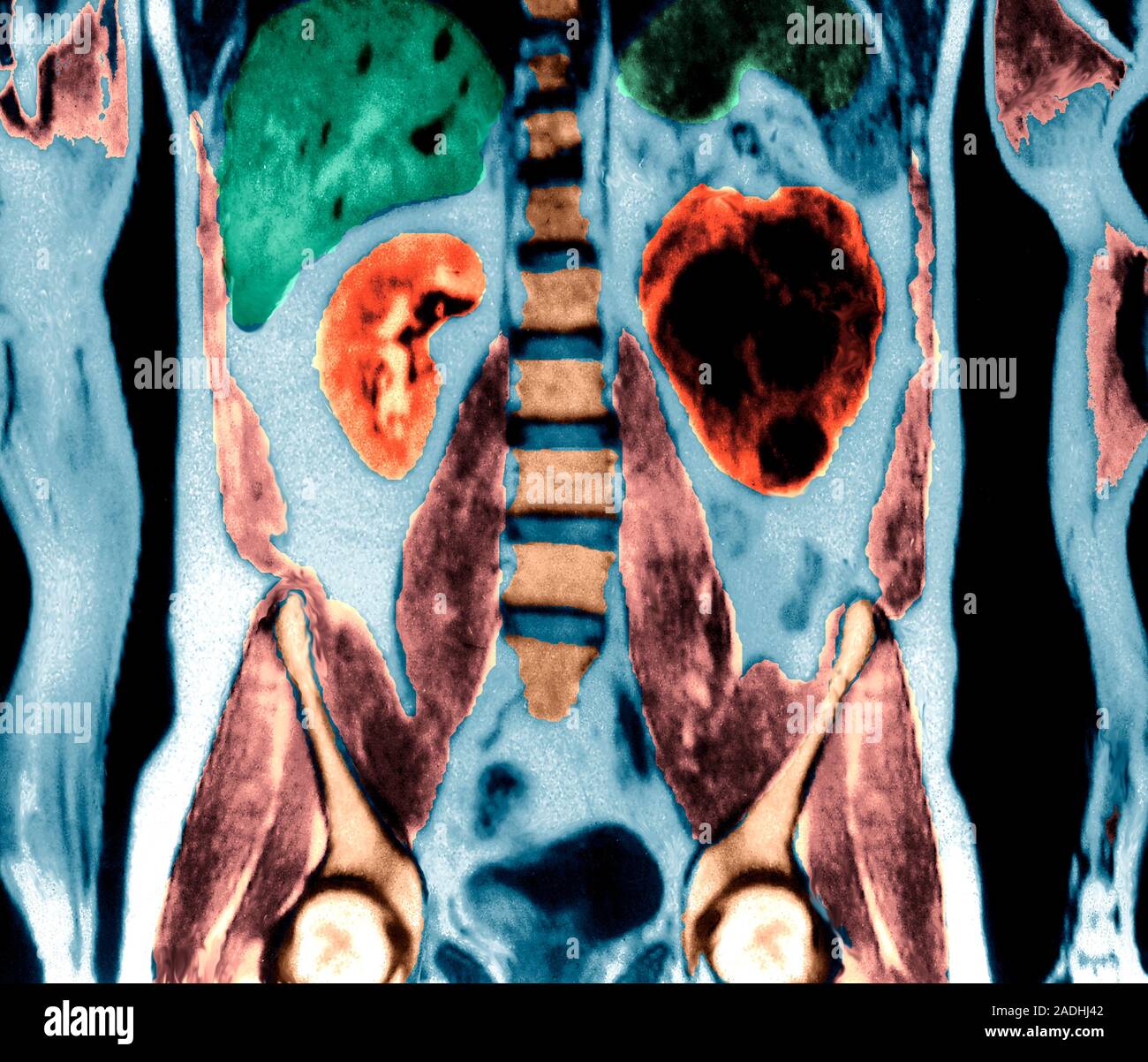 Kidney cysts. Coloured coronal (frontal) abdominal magnetic resonance ...