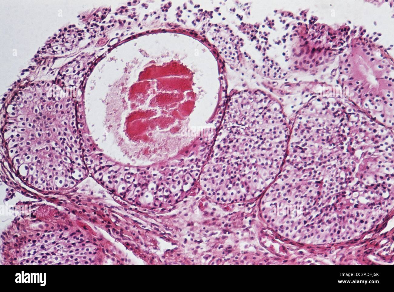 Bladder inflammation (cystitis). Light micrograph of a section through ...