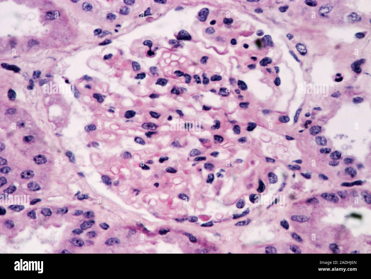 Kidney inflammation. Light micrograph of a section through a glomerulus ...