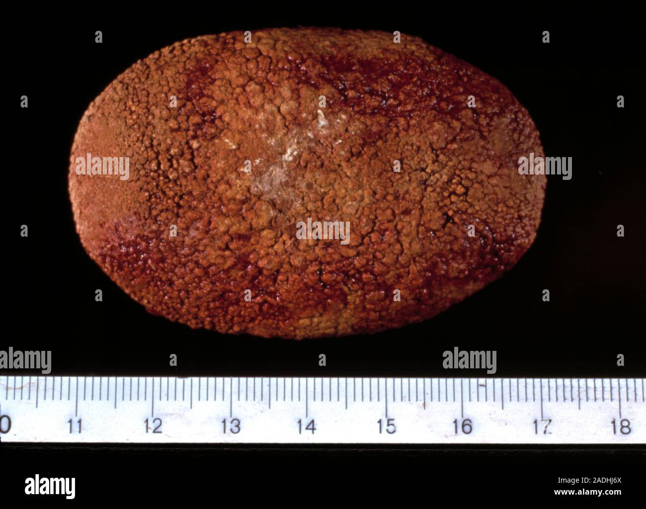 Bladder stone. Gross clinical specimen of a large bladder stone ...