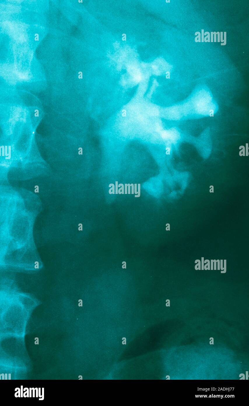 Obstructed kidney. X-ray of the obstruction of a kidney, highlighted by ...