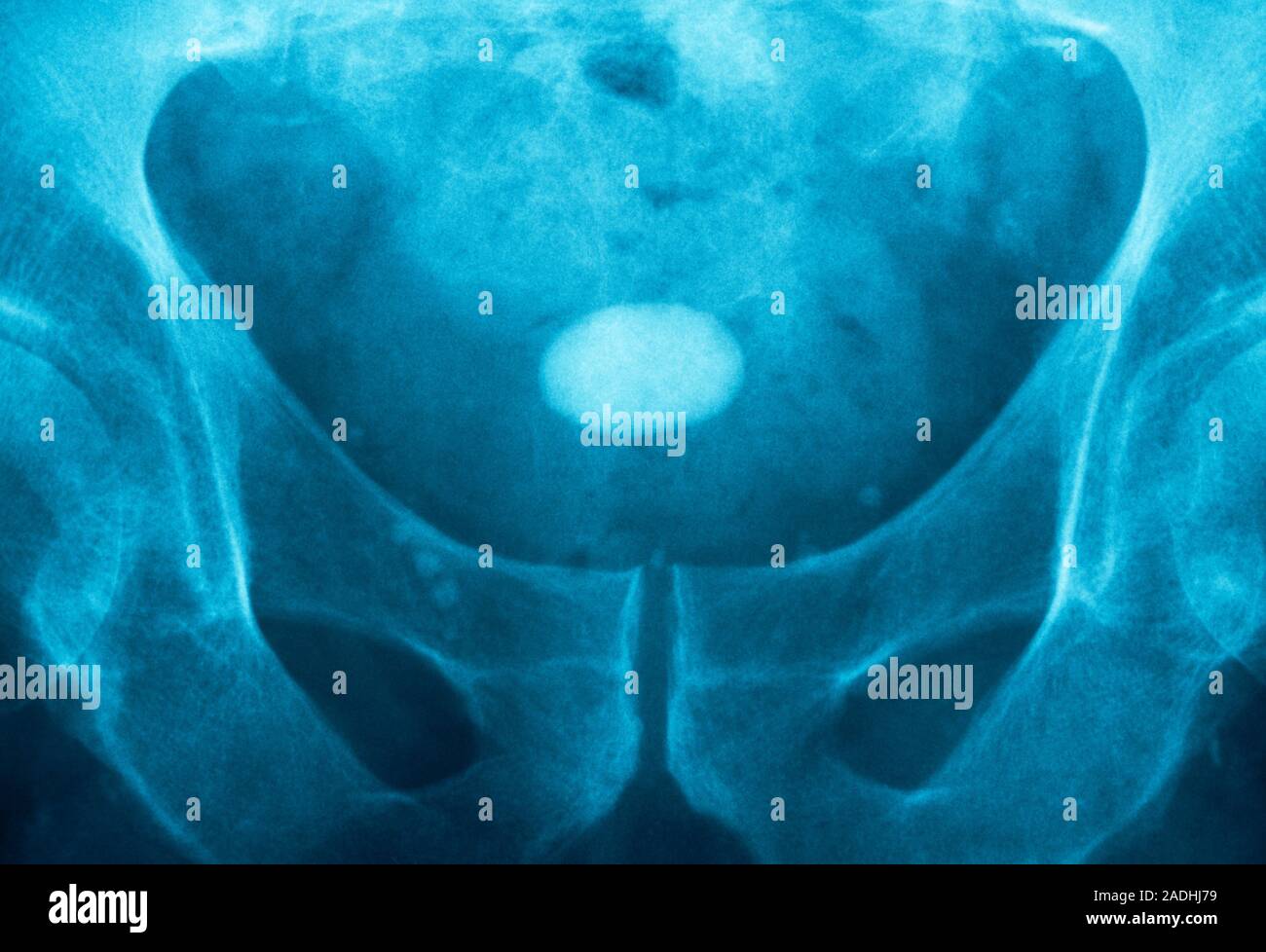 Bladder stone. X-ray of a bladder stone (round, white, centre). Also ...