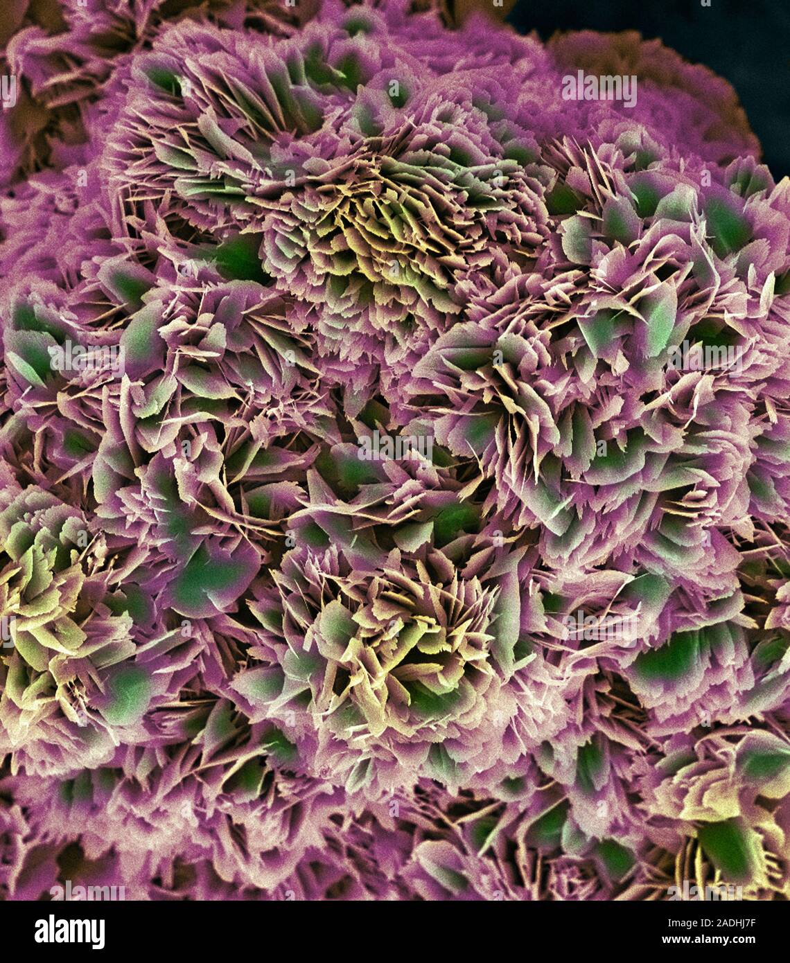 Kidney stone crystals, coloured scanning electron micrograph (SEM ...