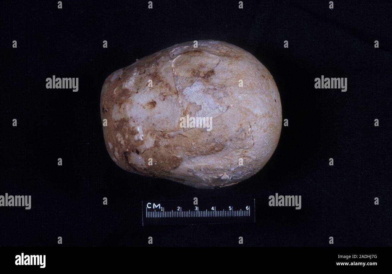 Bladder stone. Gross clinical specimen of a large bladder stone ...